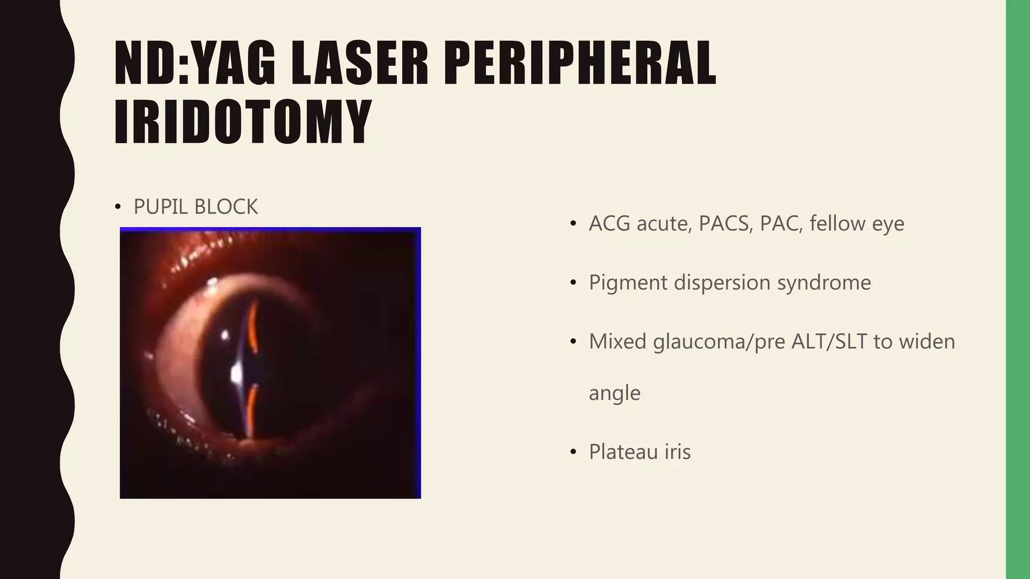 Lasers in glaucoma.pptx
