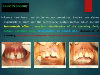 Lasers in periodontics | PPTX