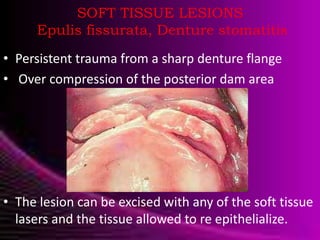 Application of Lasers in Prosthodontics | PPTX