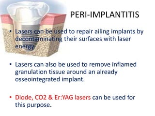 Application of Lasers in Prosthodontics | PPTX