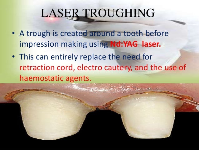 Trough Dental Surgical Extraction