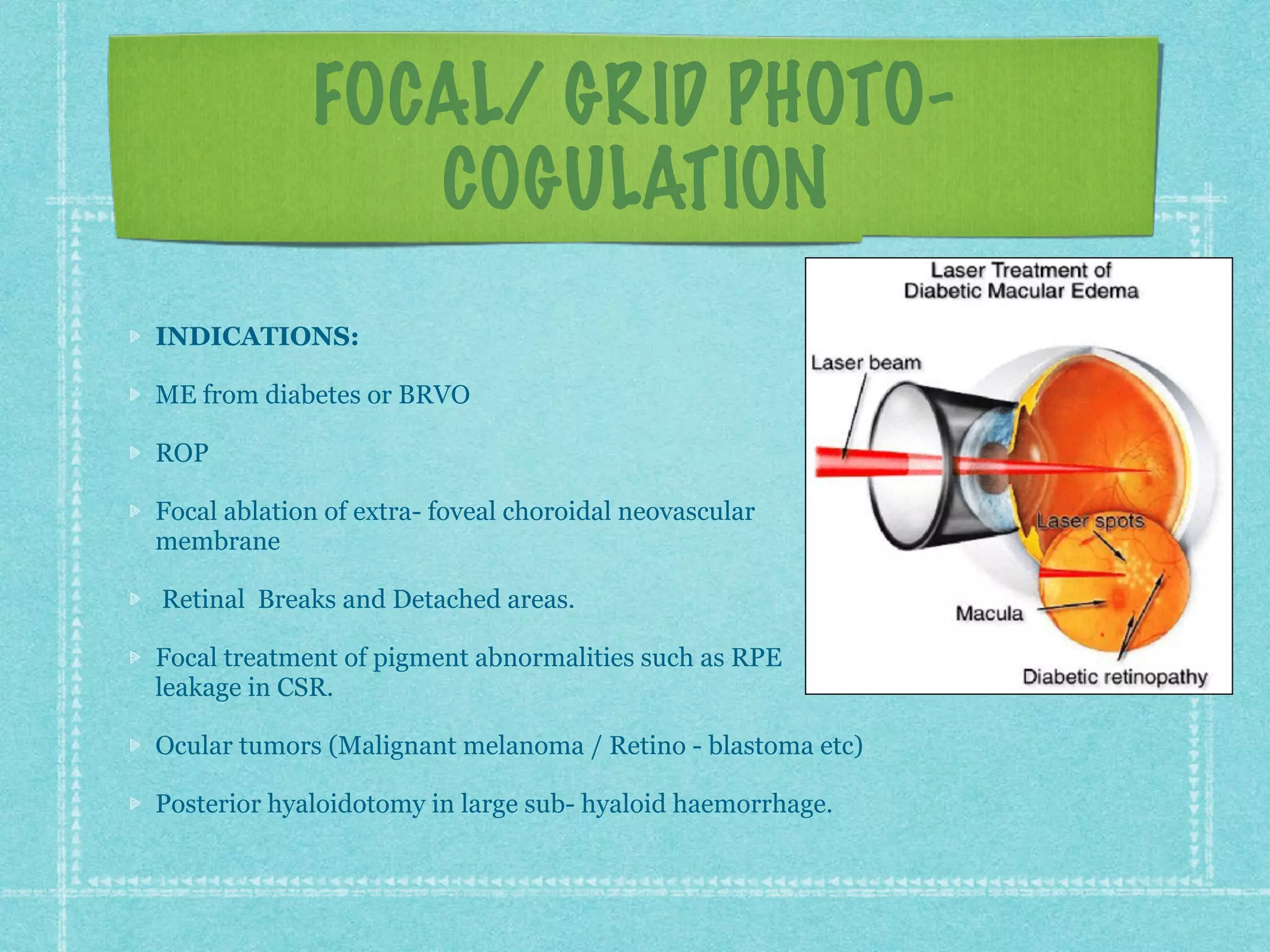 LASERS IN RETINA | PDF