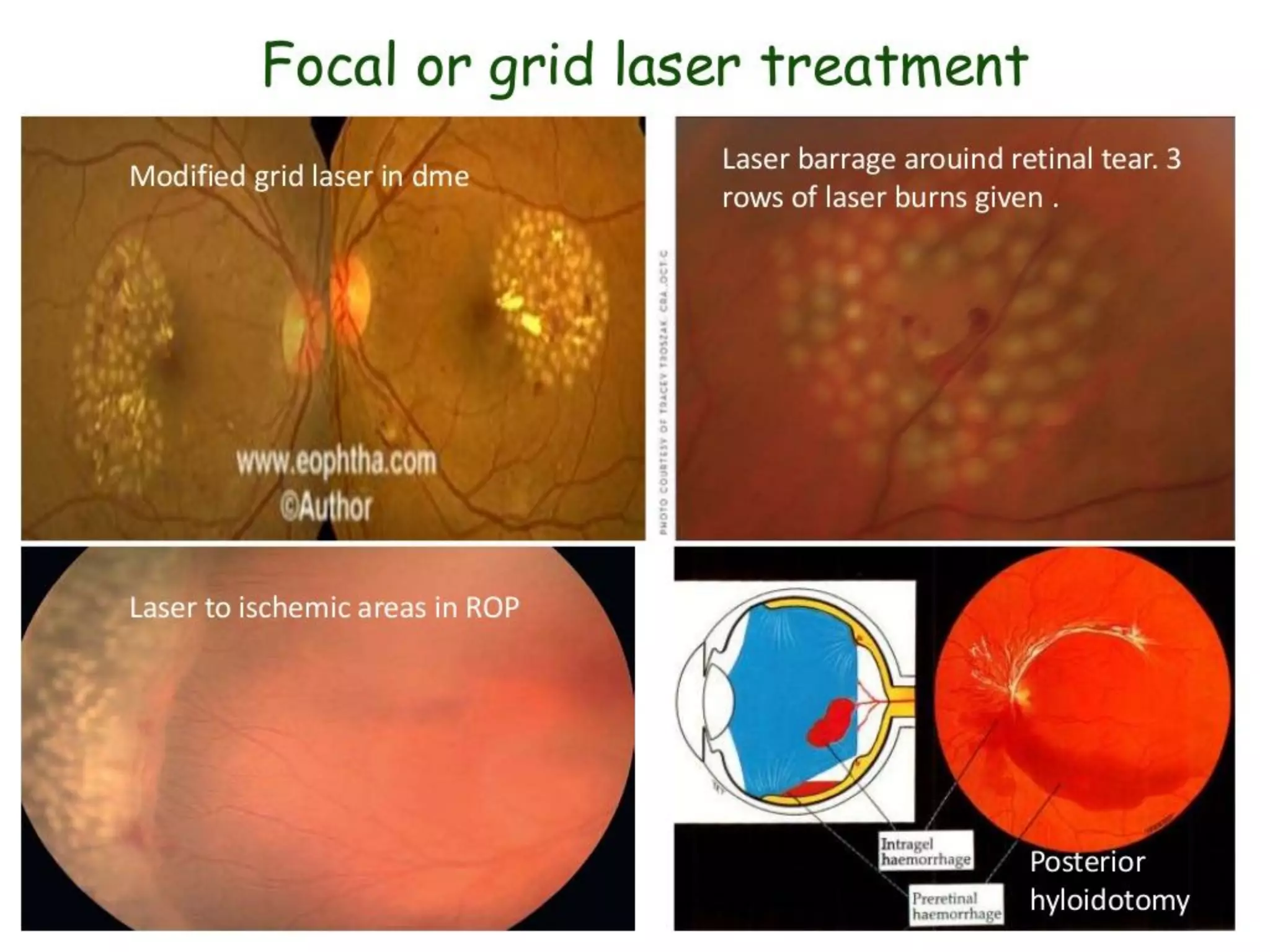 LASERS IN RETINA | PDF