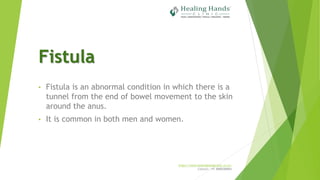 Laser Surgery for Fistula | PPTX