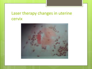 Laser therapy | PPTX