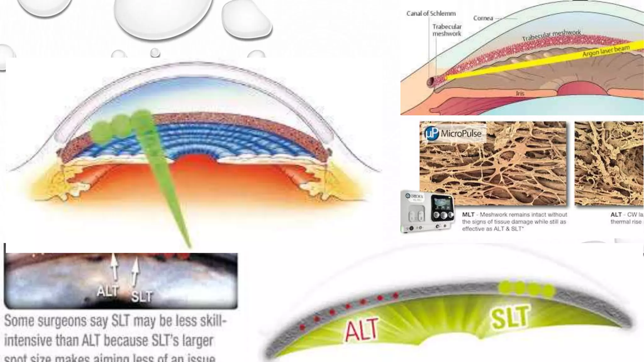 Laser therapy in glaucoma | PPTX