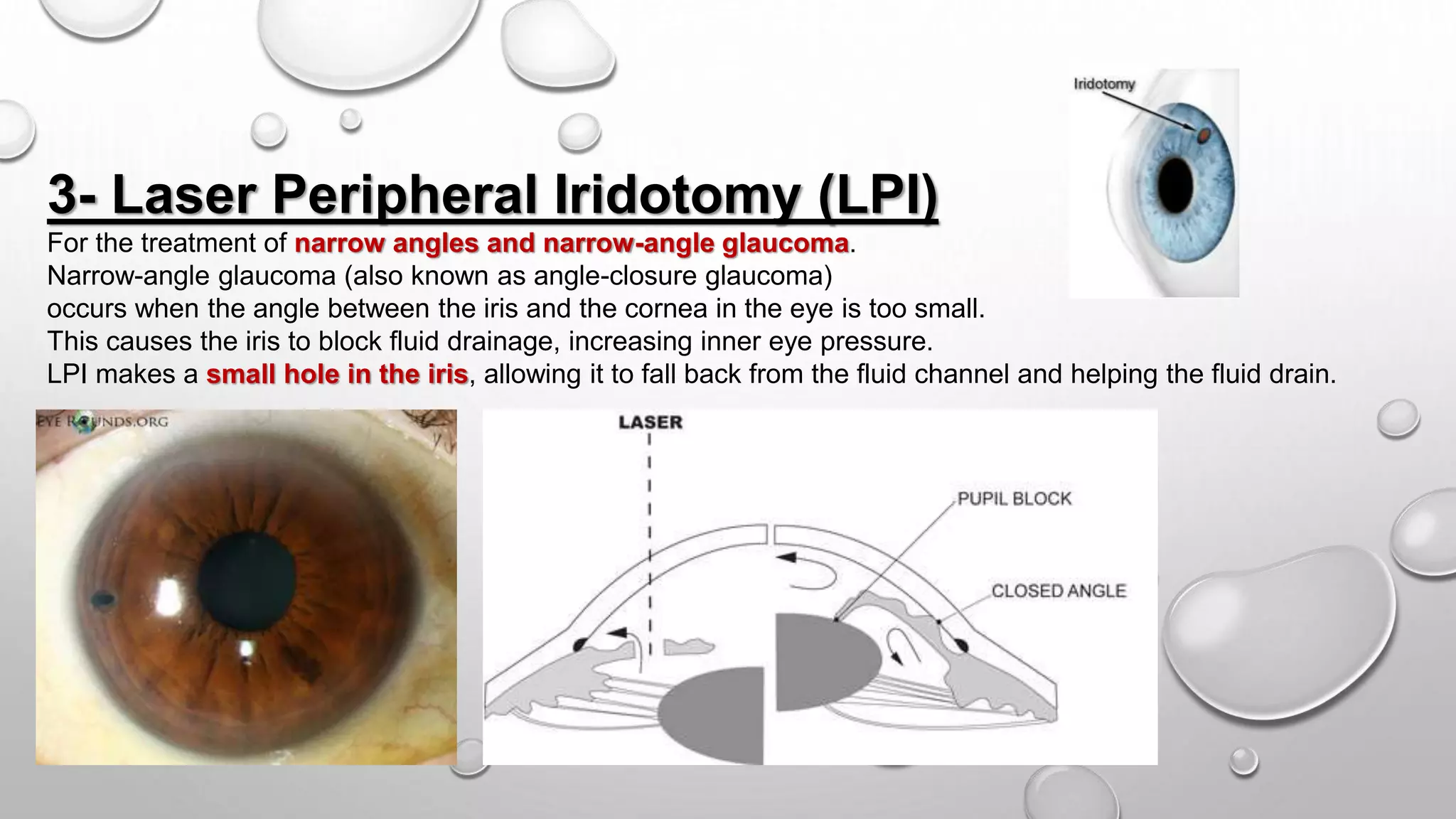 Laser therapy in glaucoma | PPTX