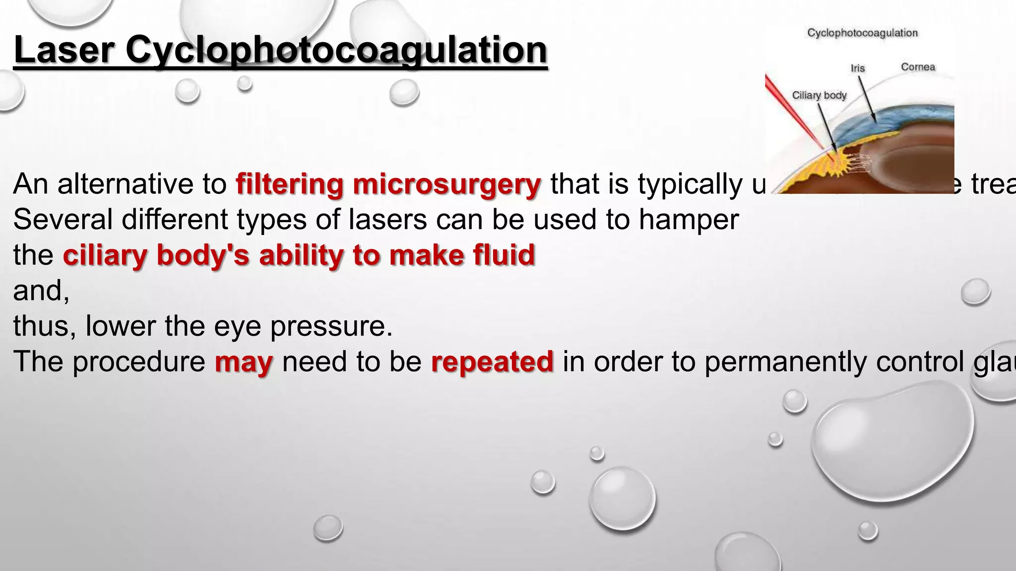 Laser therapy in glaucoma | PPTX