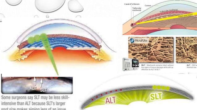 Laser therapy in glaucoma | PPTX | Eye and Vision Conditions | Diseases ...