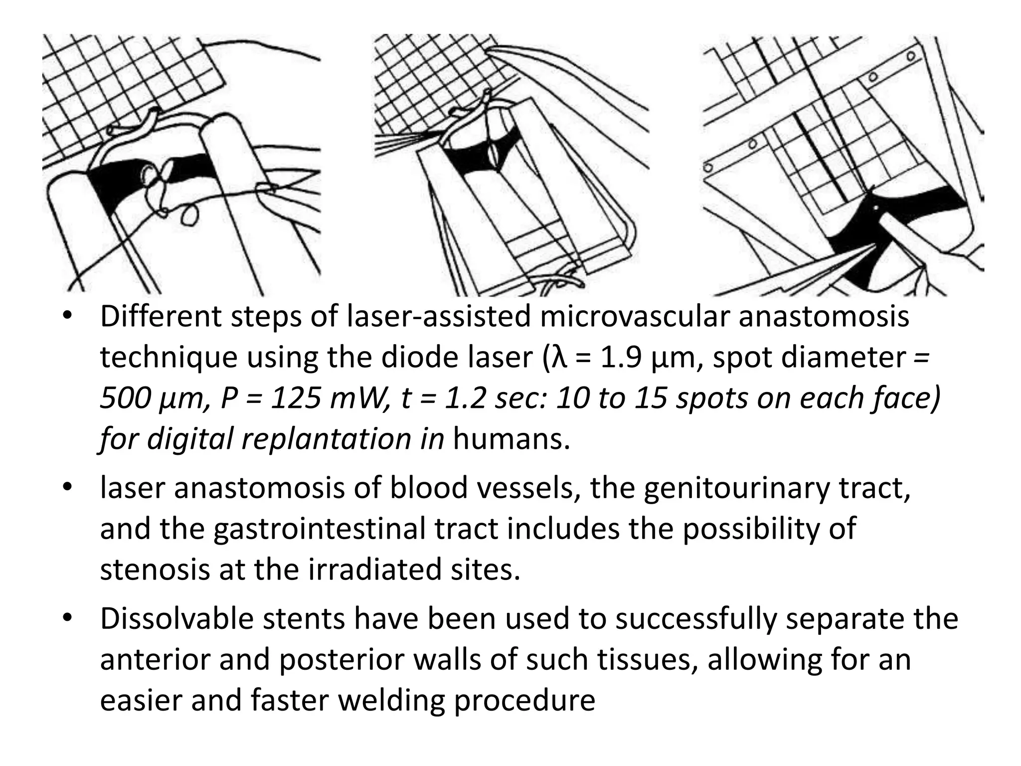 Laser Tissue Welding.ppt
