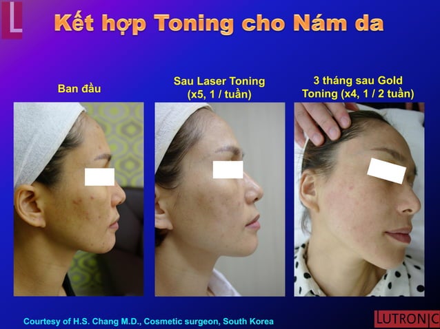 Spectra - Laser Toning 1064 & 585 nm | PDF