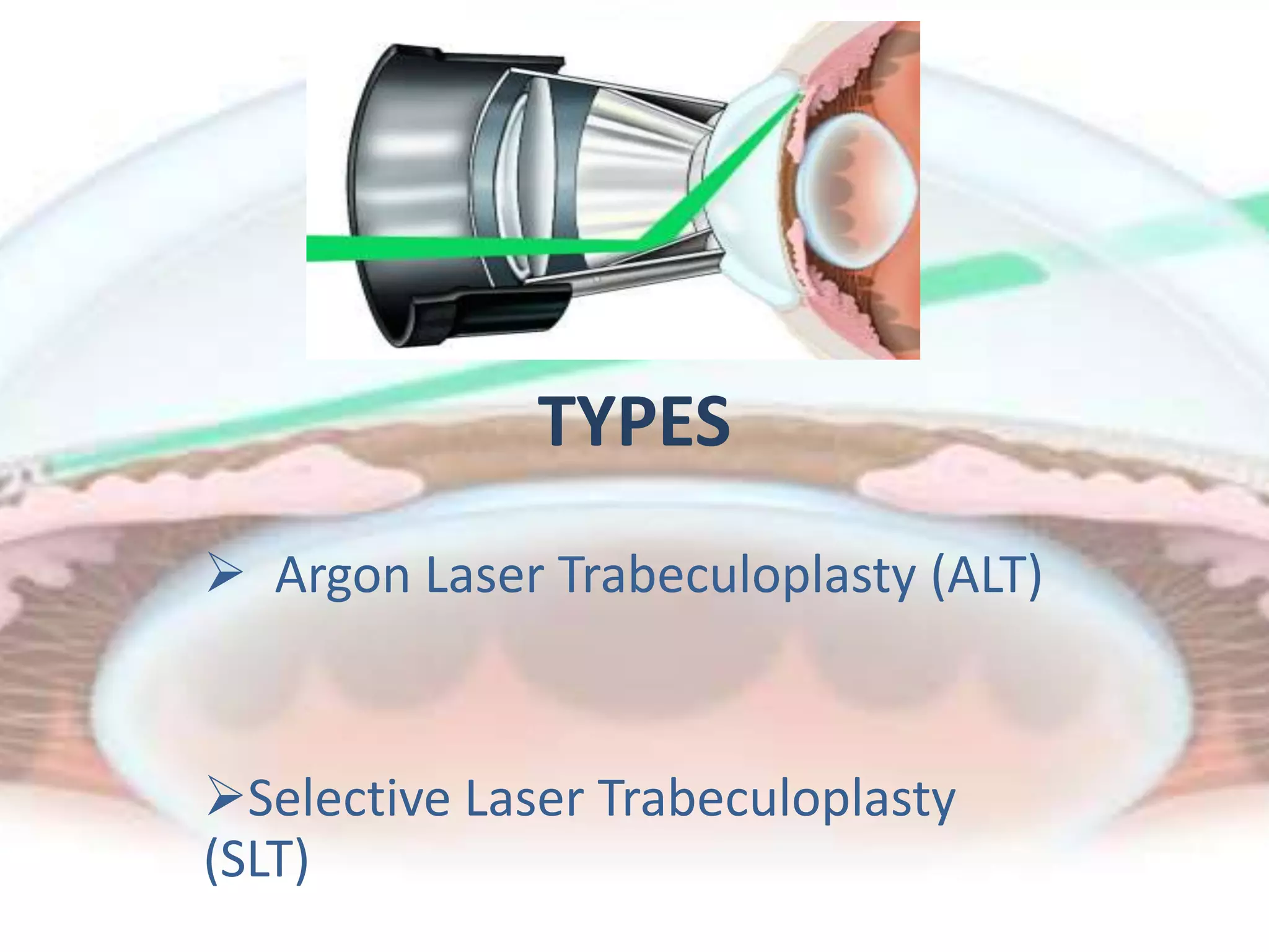 Laser trabeculoplasty | PPTX