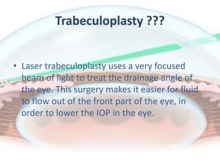 Laser trabeculoplasty | PPTX
