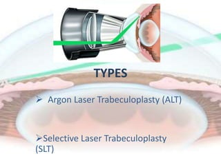Laser trabeculoplasty | PPTX