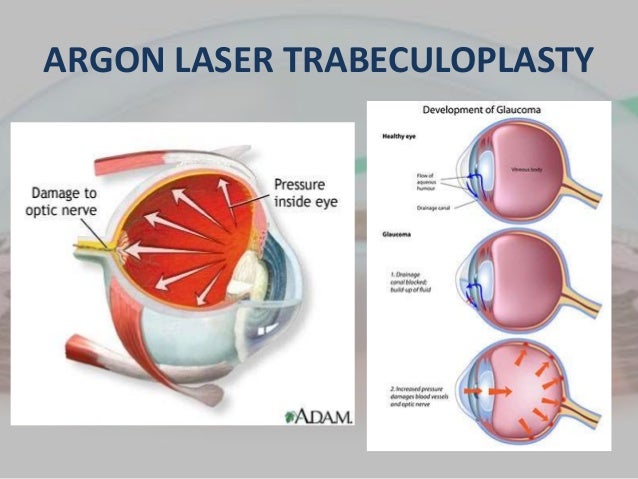 Laser trabeculoplasty