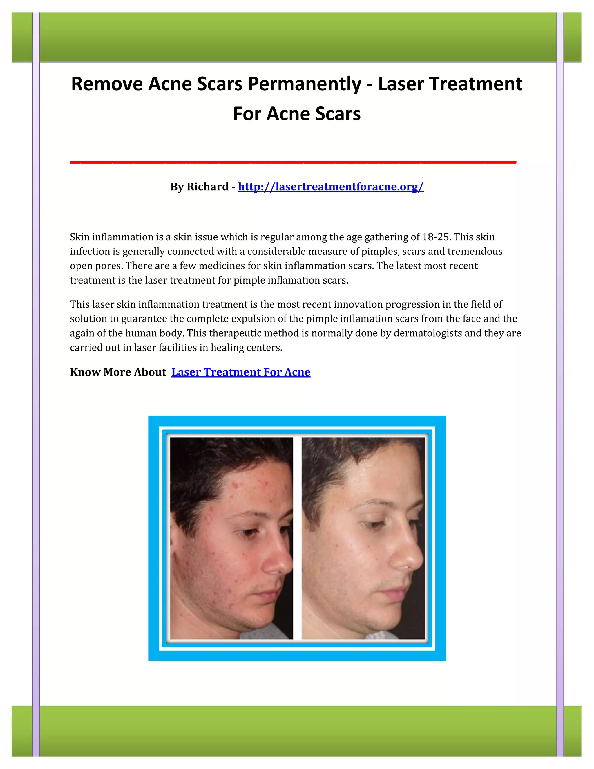 Laser treatment for acne scars | PDF