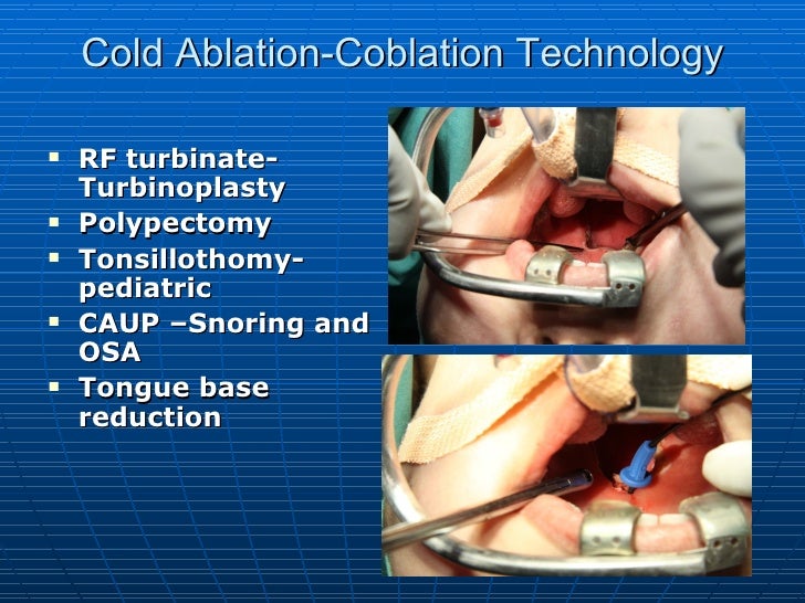 Laser Versus coblator