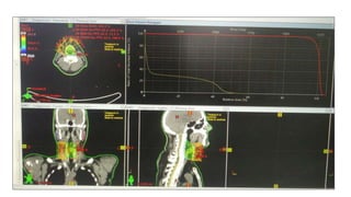 Laser vs radiation in early laryngeal SCC | PPTX