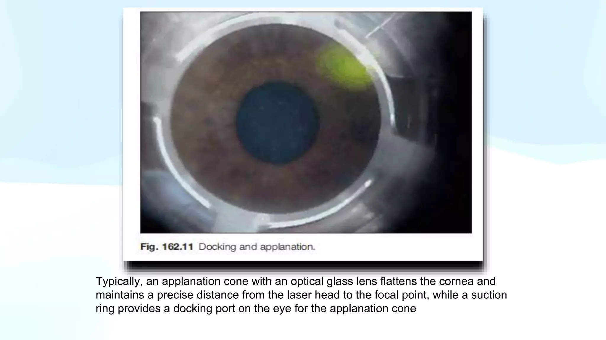 LASIK.pptx