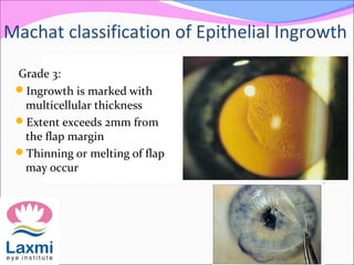 Epithelial Ingrowth
