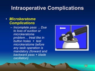 LASIK Complications.ppt