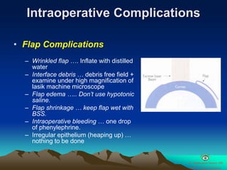 LASIK Complications.ppt