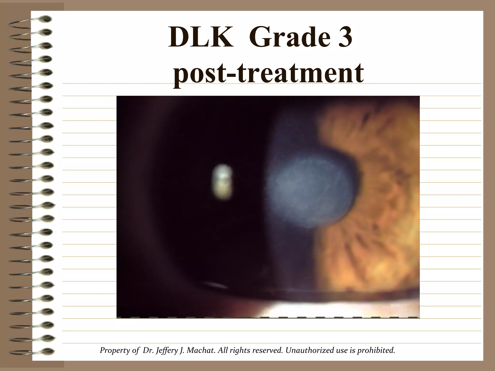 Lasik Complications 2001 Diffuse Lamellar Keratitis by Dr. Jeffery ...