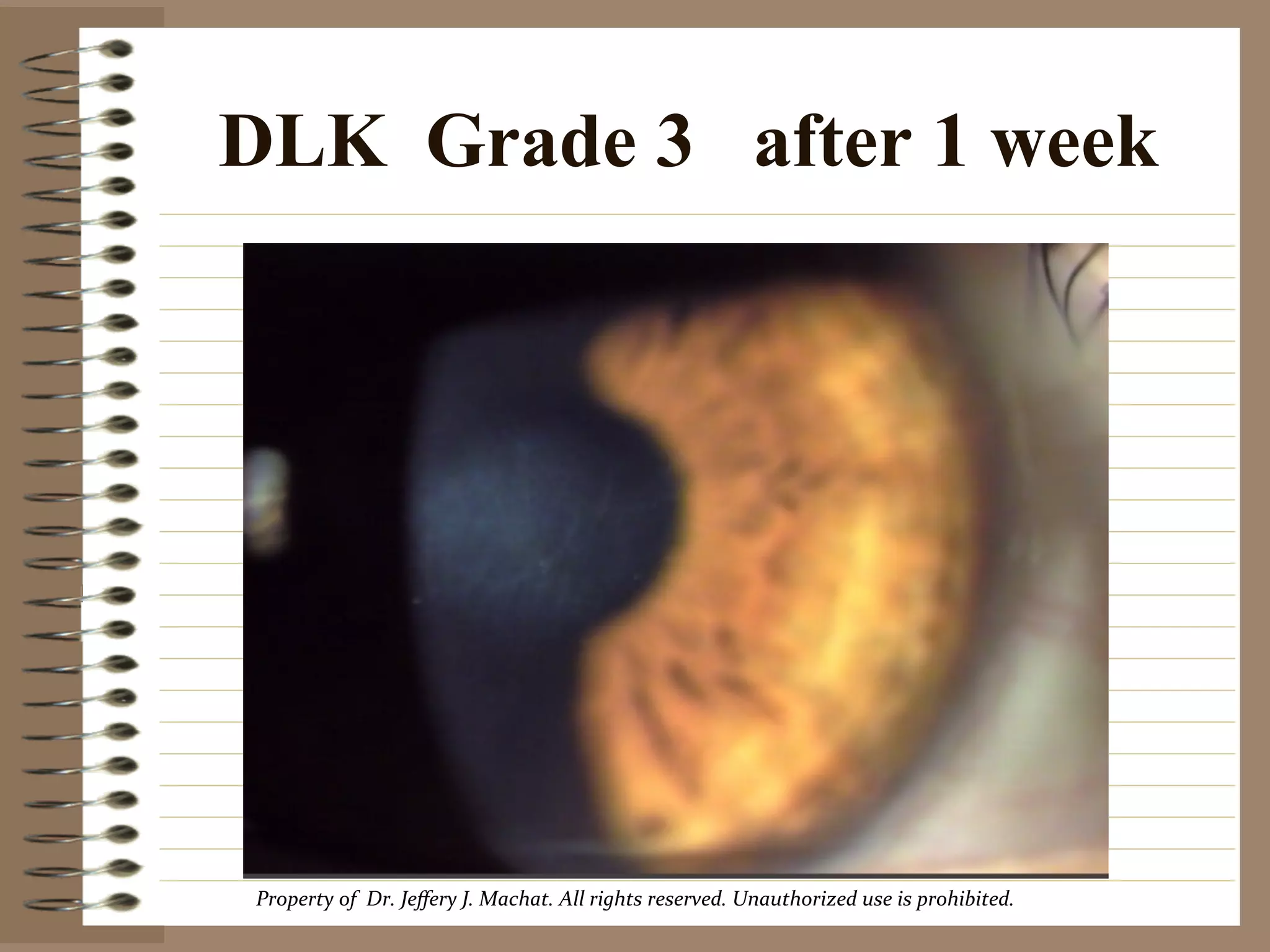 Lasik Complications 2001 Diffuse Lamellar Keratitis by Dr. Jeffery Machat | PDF