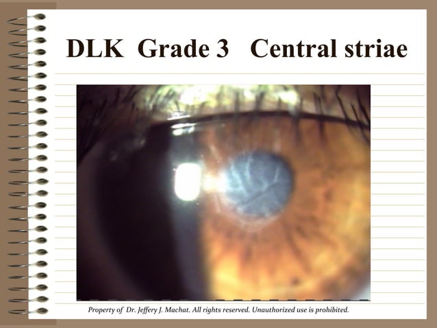 Lasik Complications 2001 Diffuse Lamellar Keratitis by Dr. Jeffery ...