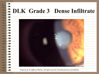 Lasik Complications 2001 Diffuse Lamellar Keratitis by Dr. Jeffery ...