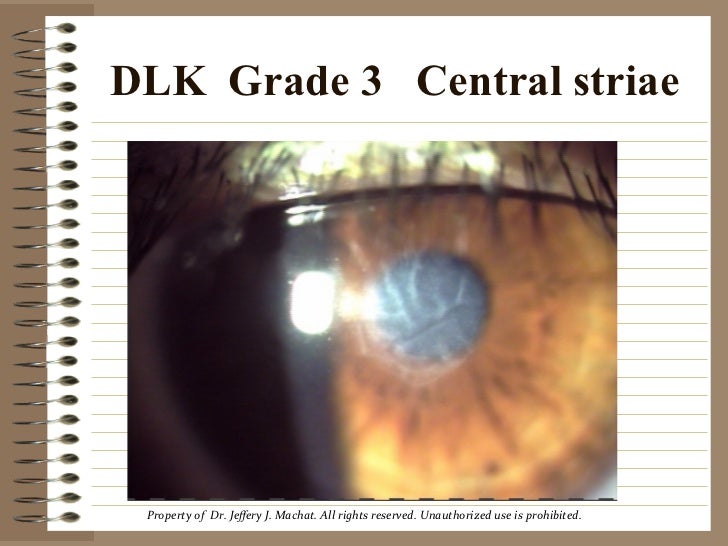 Lasik Complications 2001 Diffuse Lamellar Keratitis by Dr. Jeffery M…