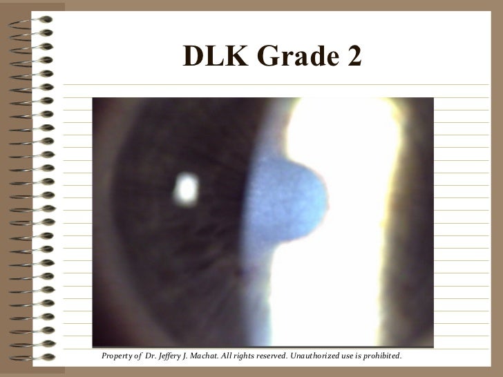 Lasik Complications 2001 Diffuse Lamellar Keratitis by Dr. Jeffery M…