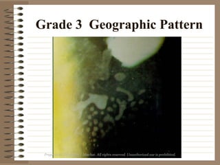 Lasik Complications 2001 Epithelial Ingrowth by Dr. Jeffery Machat | PDF