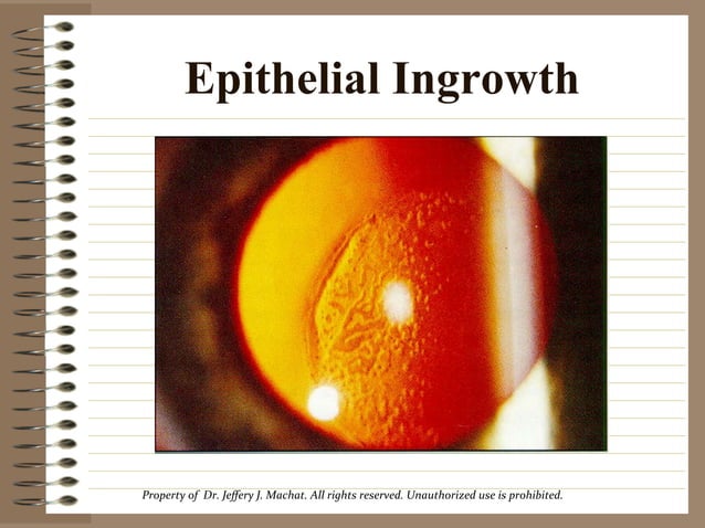 Lasik Complications 2001 Epithelial Ingrowth by Dr. Jeffery Machat | PDF