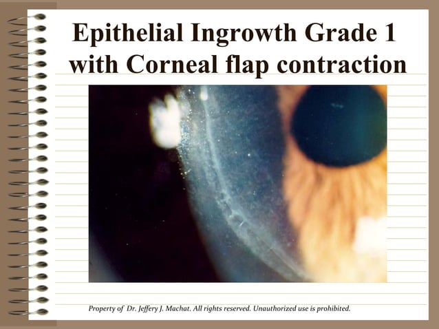 Lasik Complications 2001 Epithelial Ingrowth by Dr. Jeffery Machat | PDF