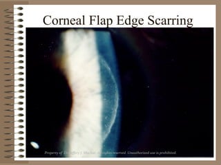 Lasik Complications 2001 Epithelial Ingrowth by Dr. Jeffery Machat | PDF