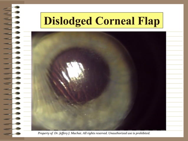 Lasik Complications 2001 Striae by Dr. Jeffery Machat | PPT
