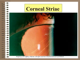 Lasik Complications 2001 Striae by Dr. Jeffery Machat | PDF