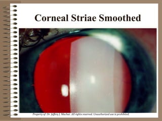 Lasik Complications 2001 Striae by Dr. Jeffery Machat | PDF | Eye and ...