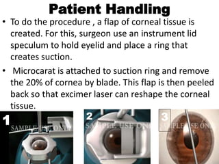 LASIK Eye Surgery | PPT
