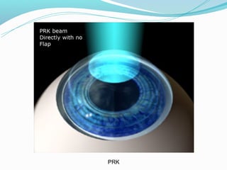 LASIK Eye Surgery Procedures | PPT