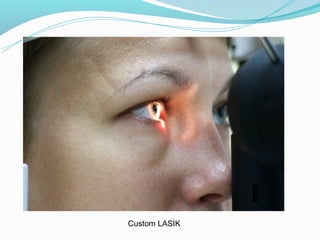 LASIK Eye Surgery Procedures | PPT