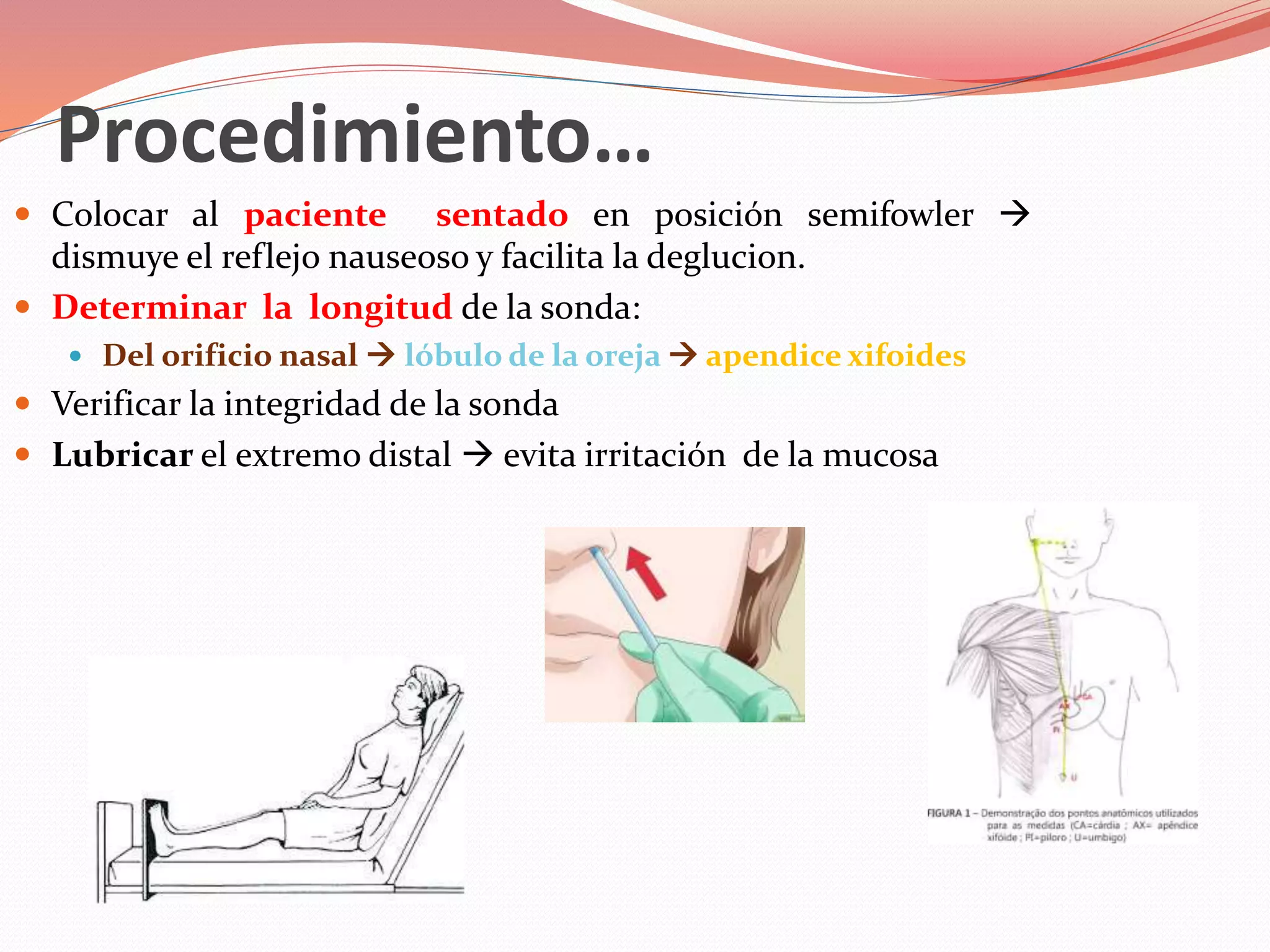 La sonda nasogastrica | PPTX