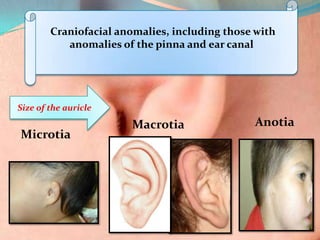 risk factors for hearing loss among newborns (ENT) | PPTX