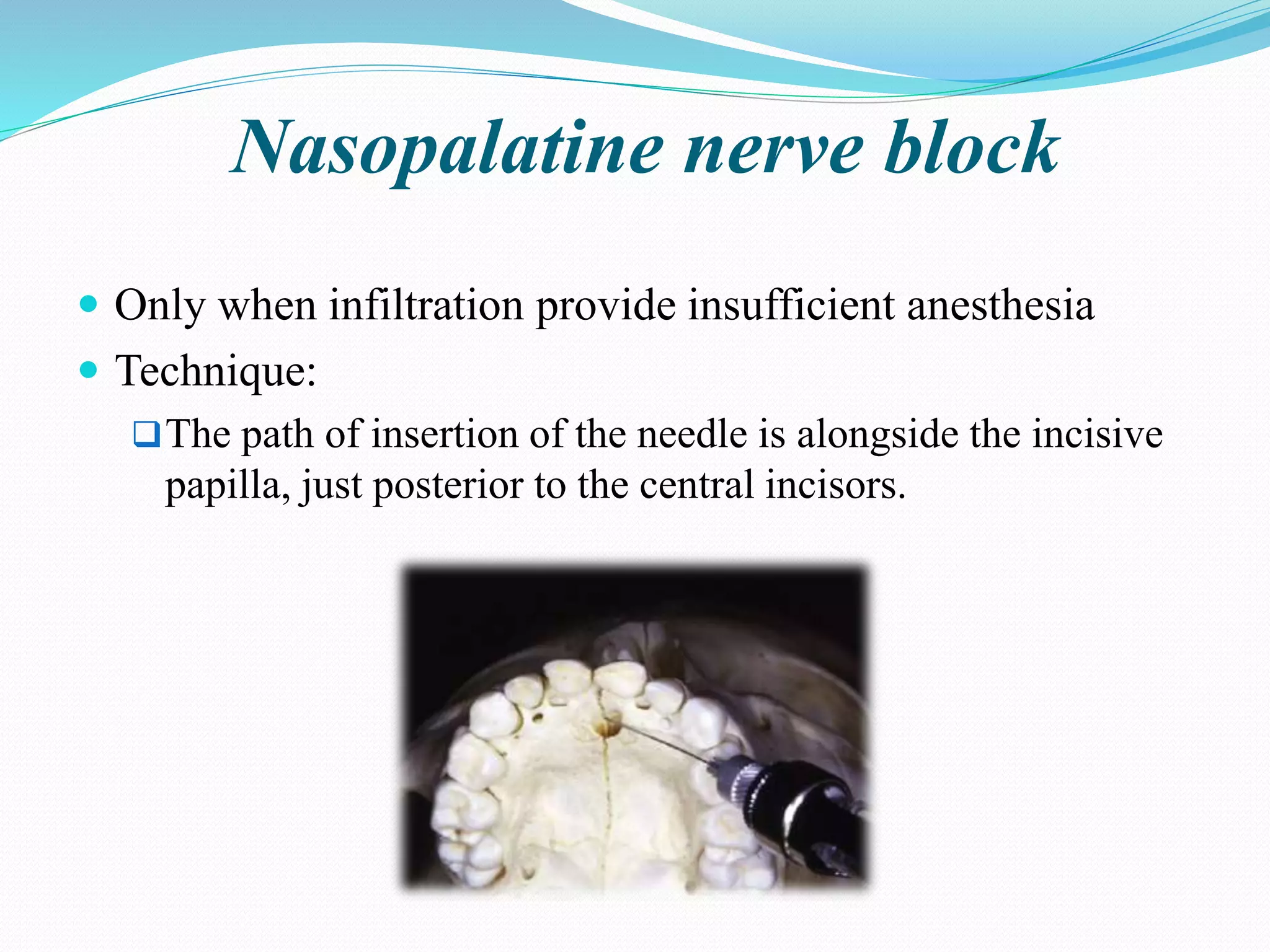 Local Anesthesia and Pain Control Pediatric Dentistry by Dr. Ahmed Sami ...