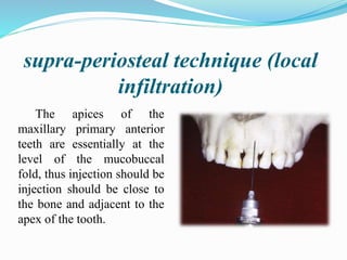 Local Anesthesia and Pain Control Pediatric Dentistry by Dr. Ahmed Sami ...