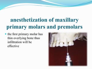 Local Anesthesia and Pain Control Pediatric Dentistry by Dr. Ahmed Sami ...