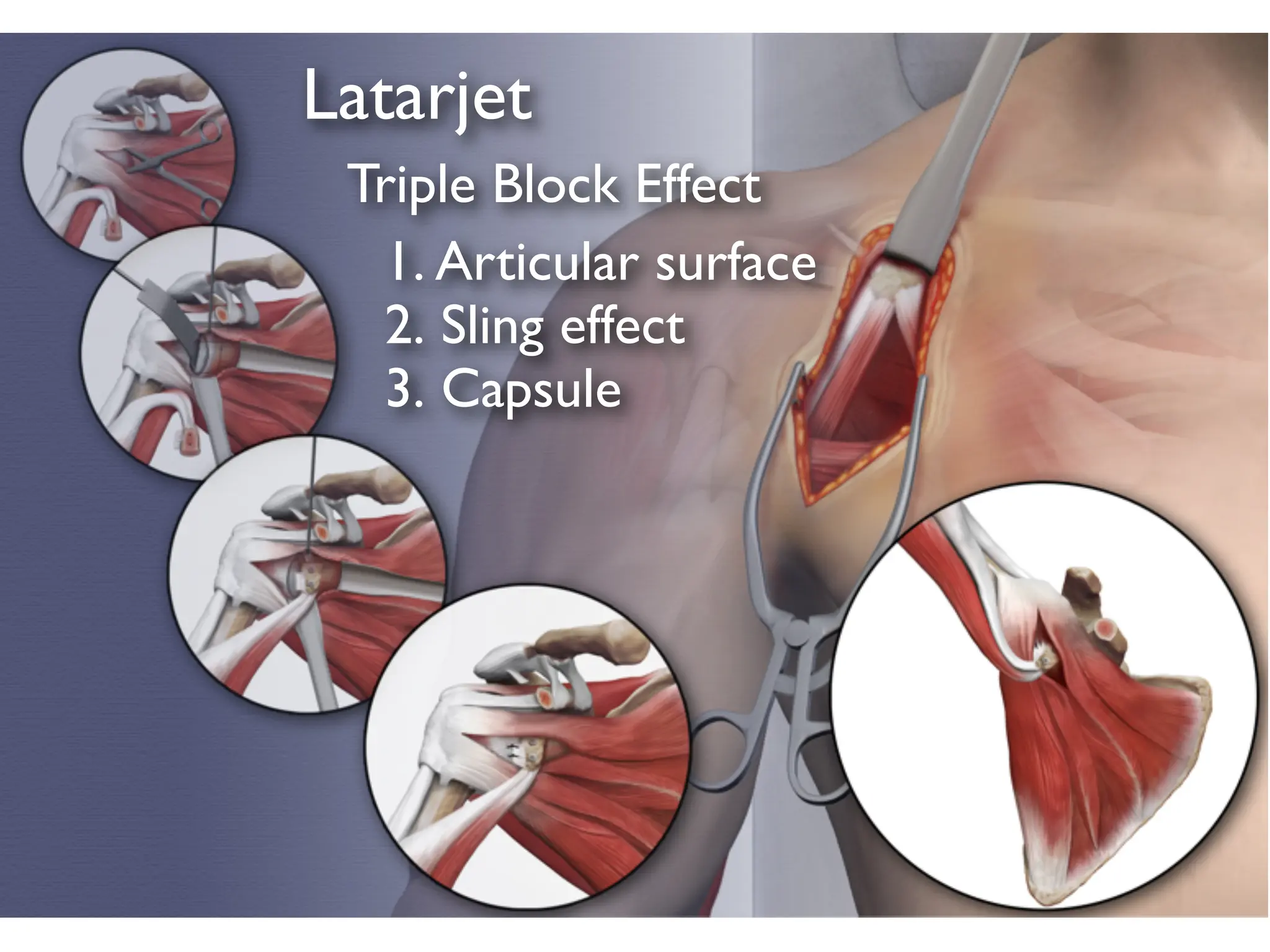 Latarjet Indications for Shoulder Dislocations and Instability in ...