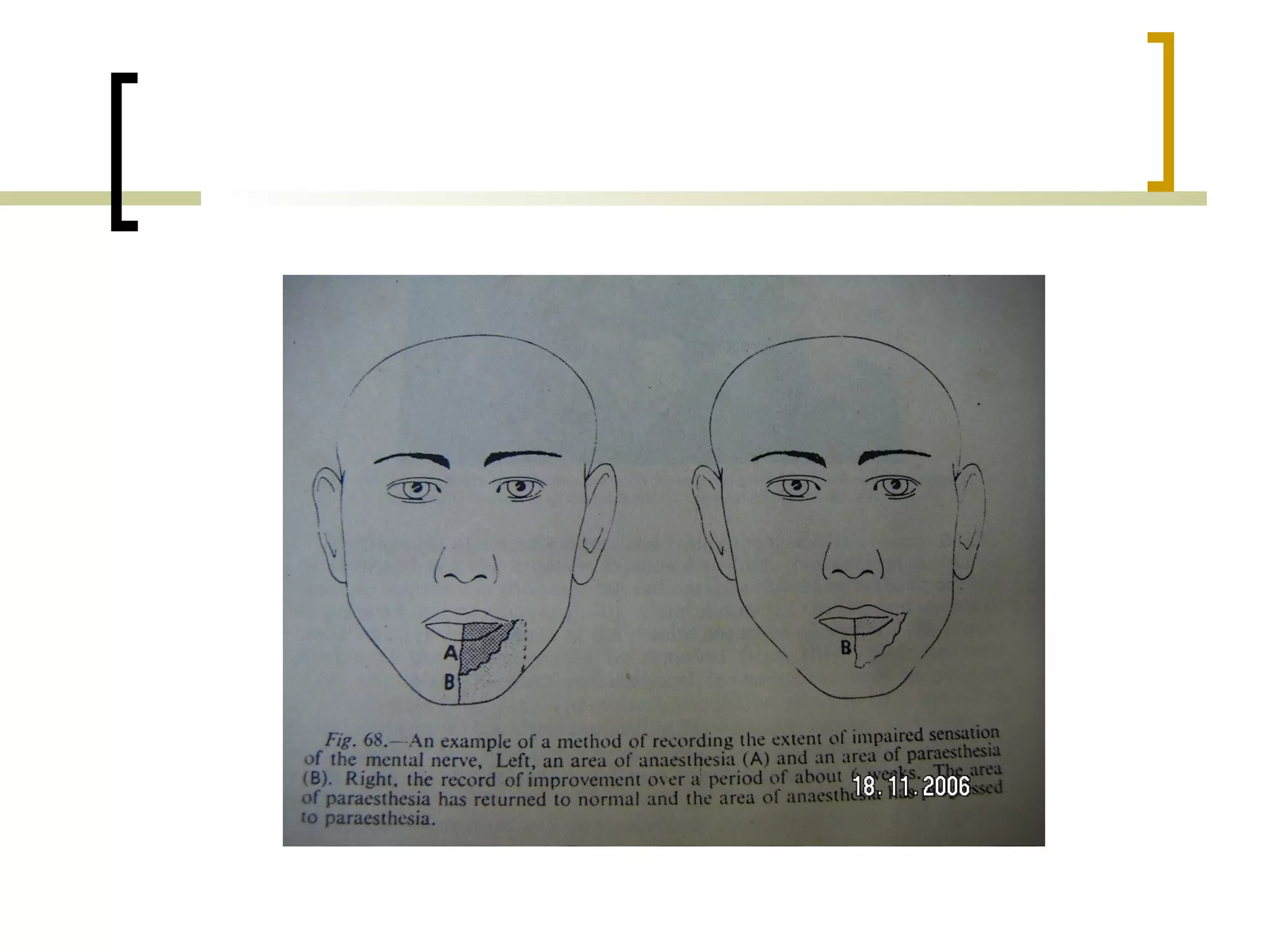 Local Anesthesia Injection Technique | PPT