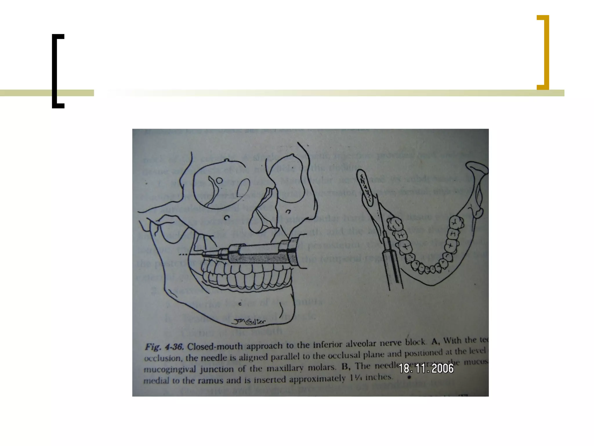Local Anesthesia Injection Technique | PPT